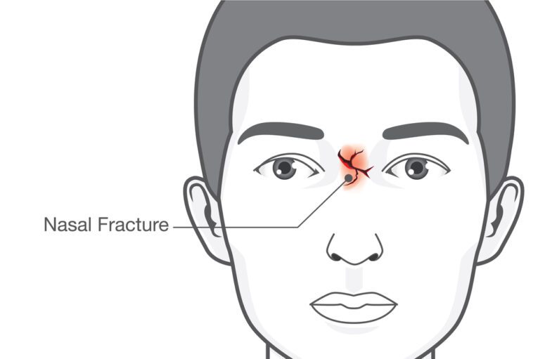 Nose Fracture : Overview, Causes, Symptoms, Treatment - illness.com