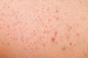 Rubor : Overview, Causes, Symptoms, Treatment - illness.com