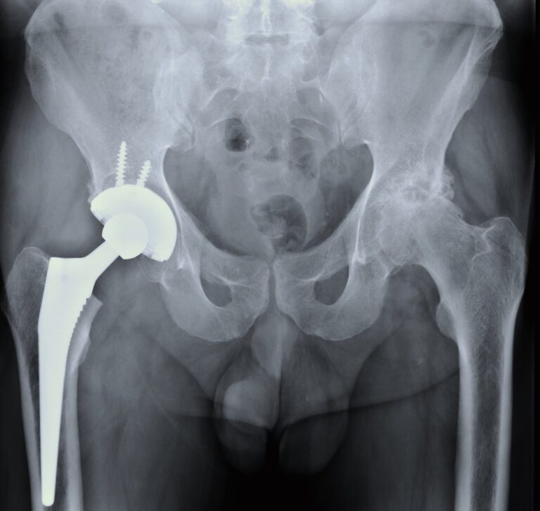 Hip Fracture : Overview, Causes, Symptoms, Treatment - illness.com