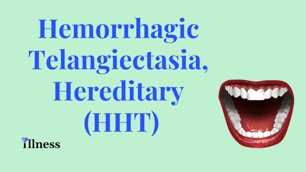 Hereditary Hemorrhagic Telangiectasia (HHT) : Overview, Causes ...