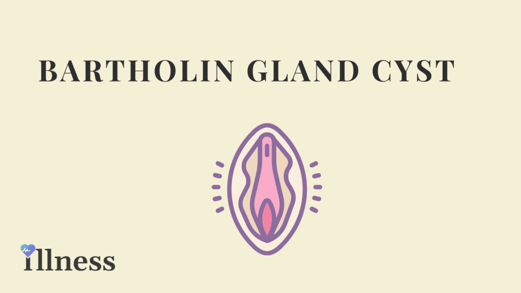 Bartholin's Gland Cyst : Overview, Causes, Symptoms, Treatment ...