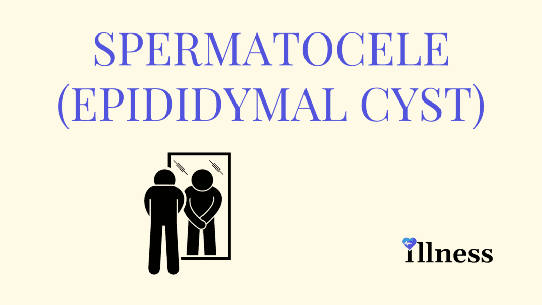 Spermatocele (Epididymal Cyst) : Overview, Causes, Symptoms, Treatment ...