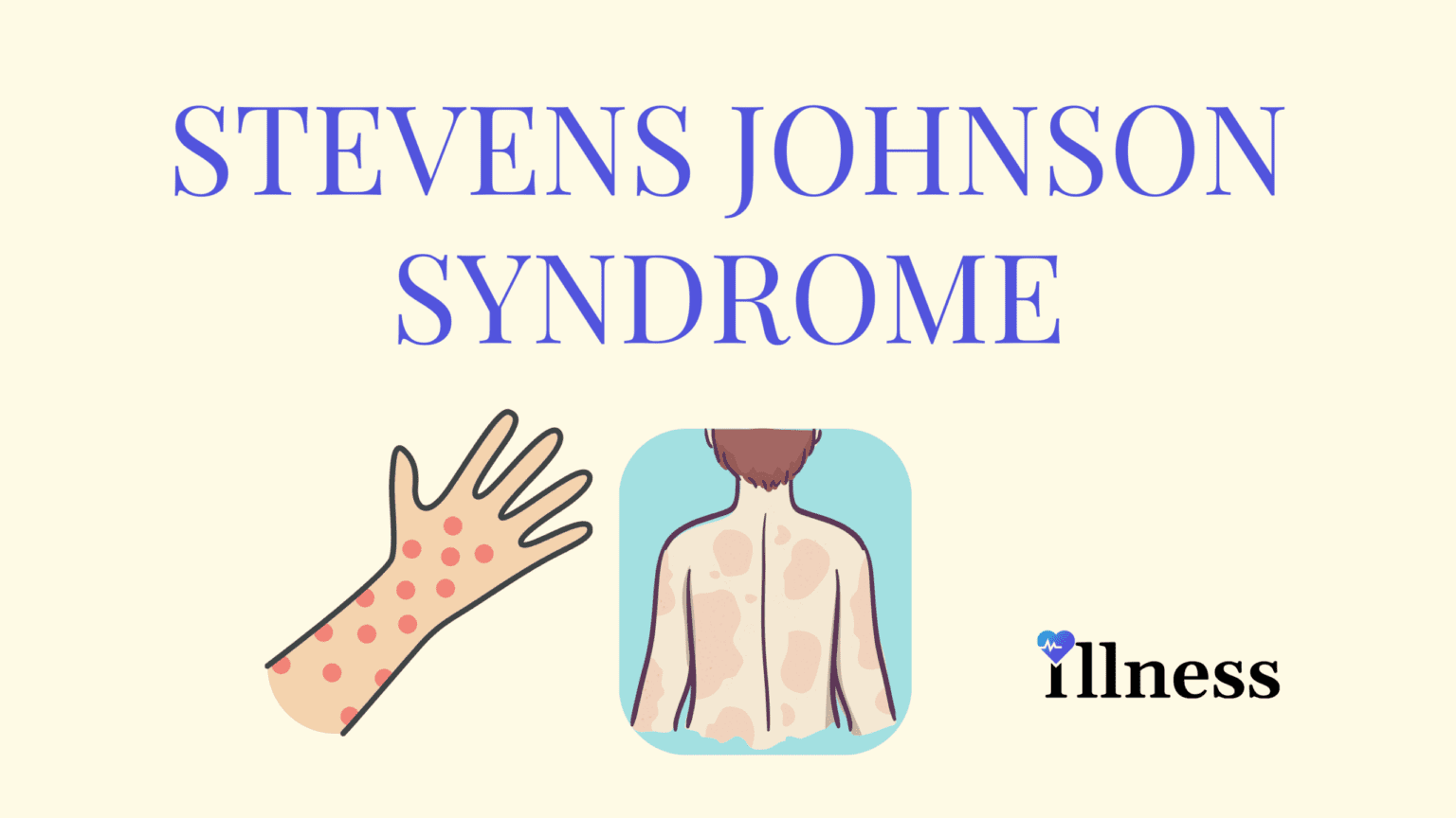 Stevens-Johnson Syndrome : Overview, Causes, Symptoms, Treatment ...