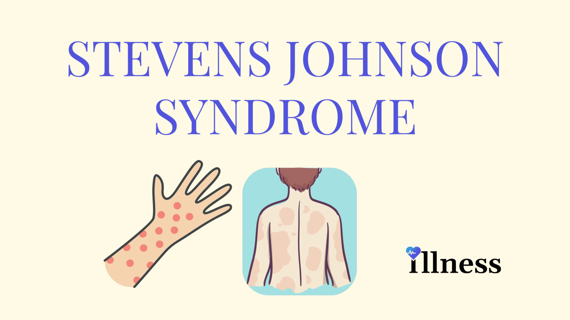Stevens-Johnson Syndrome : Overview - illness.com