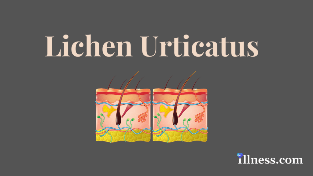 Lichen Simplex Chronicus : Overview, Causes, Symptoms, Treatment ...
