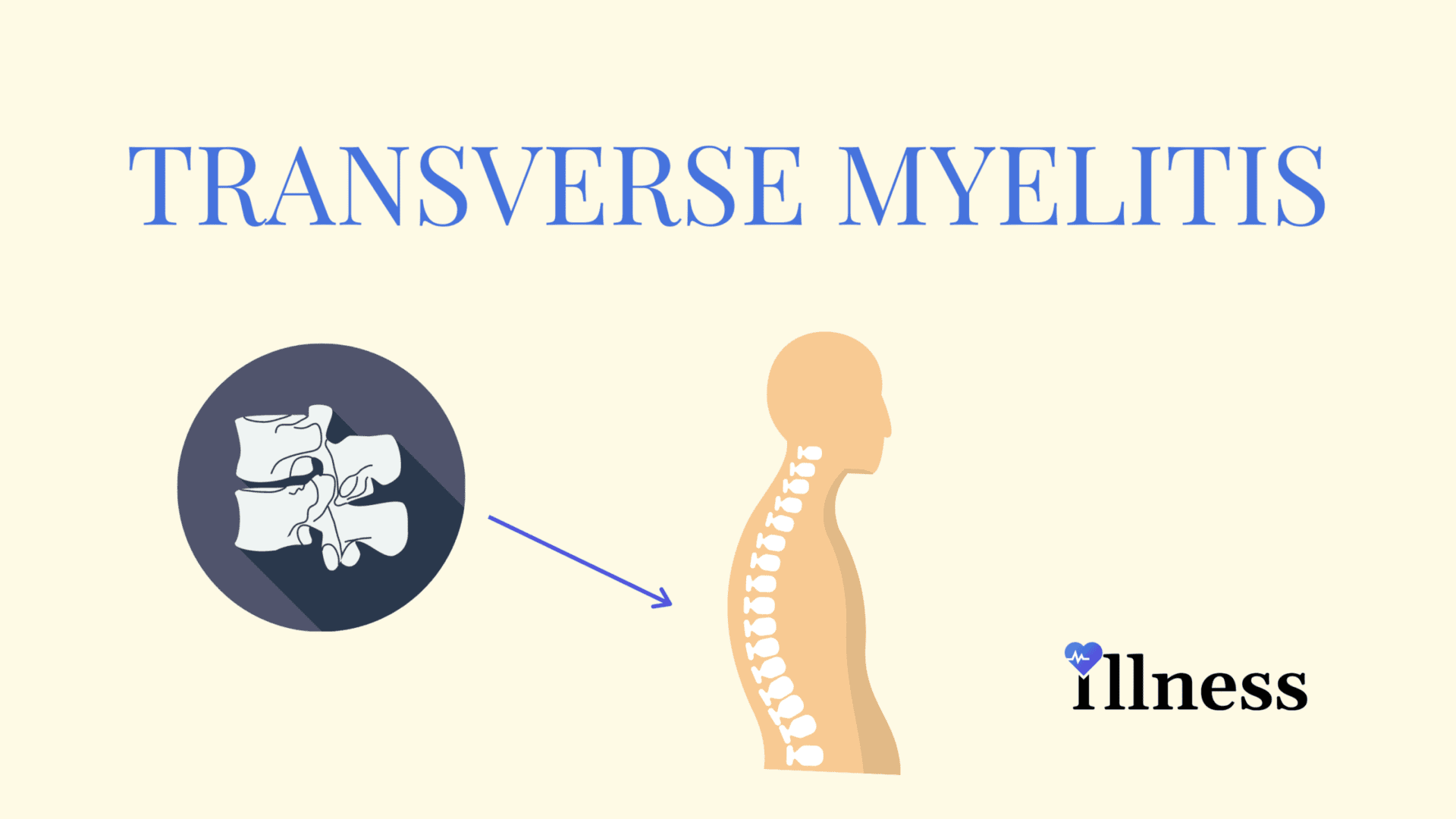 Acute Transverse Myelitis : Overview, Causes, Symptoms, Treatment ...