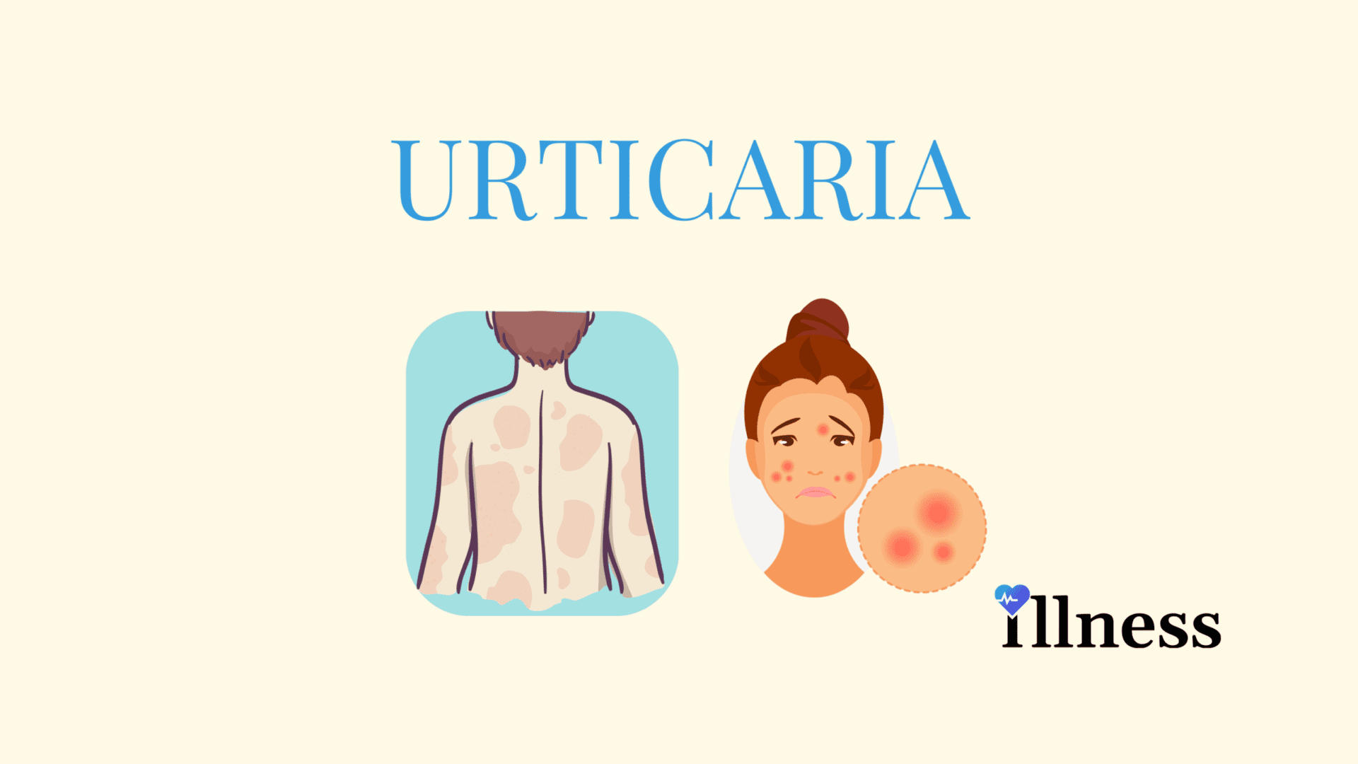 Urticaria - Hives: Overview, Causes, Symptoms, Treatment - illness.com