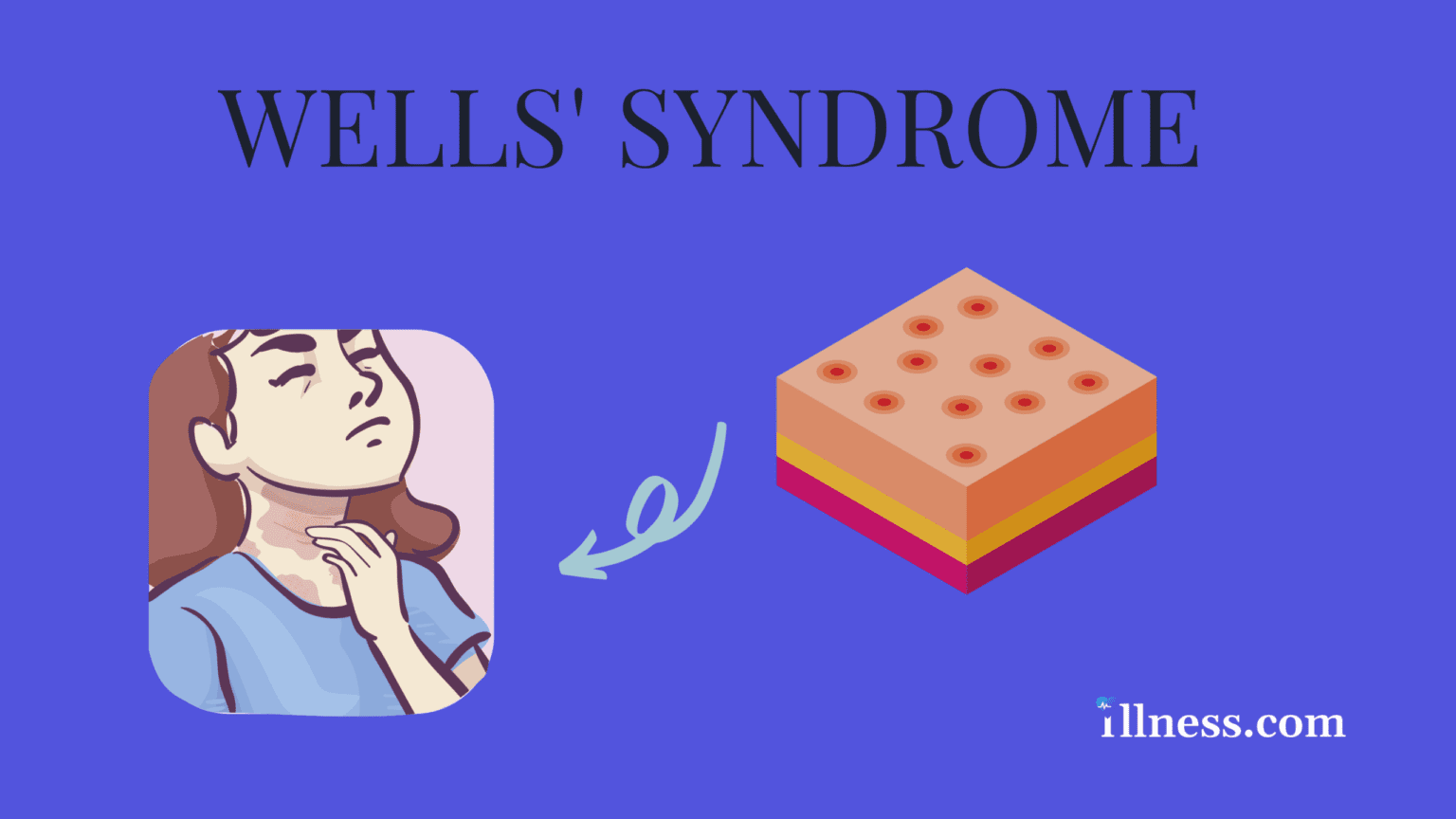 Muckle-Wells Syndrome : Overview, Causes, Symptoms, Treatment - illness.com
