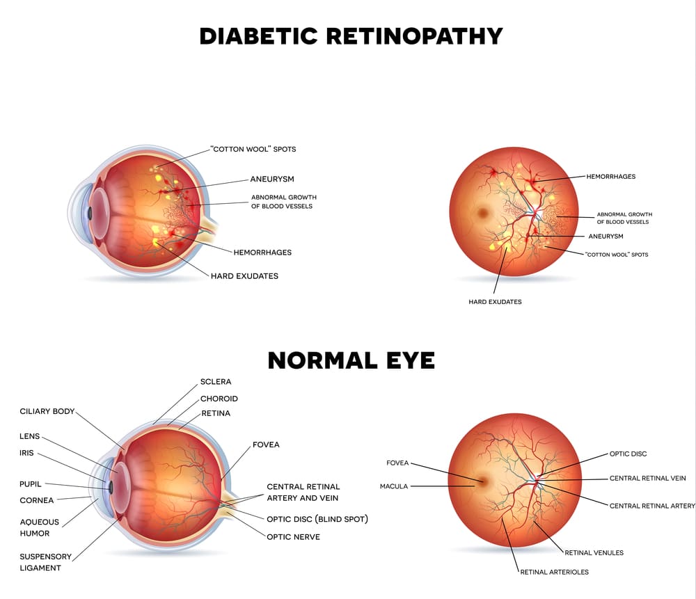 Diabetic Eye Disease Overview Causes Symptoms Treatment Illness